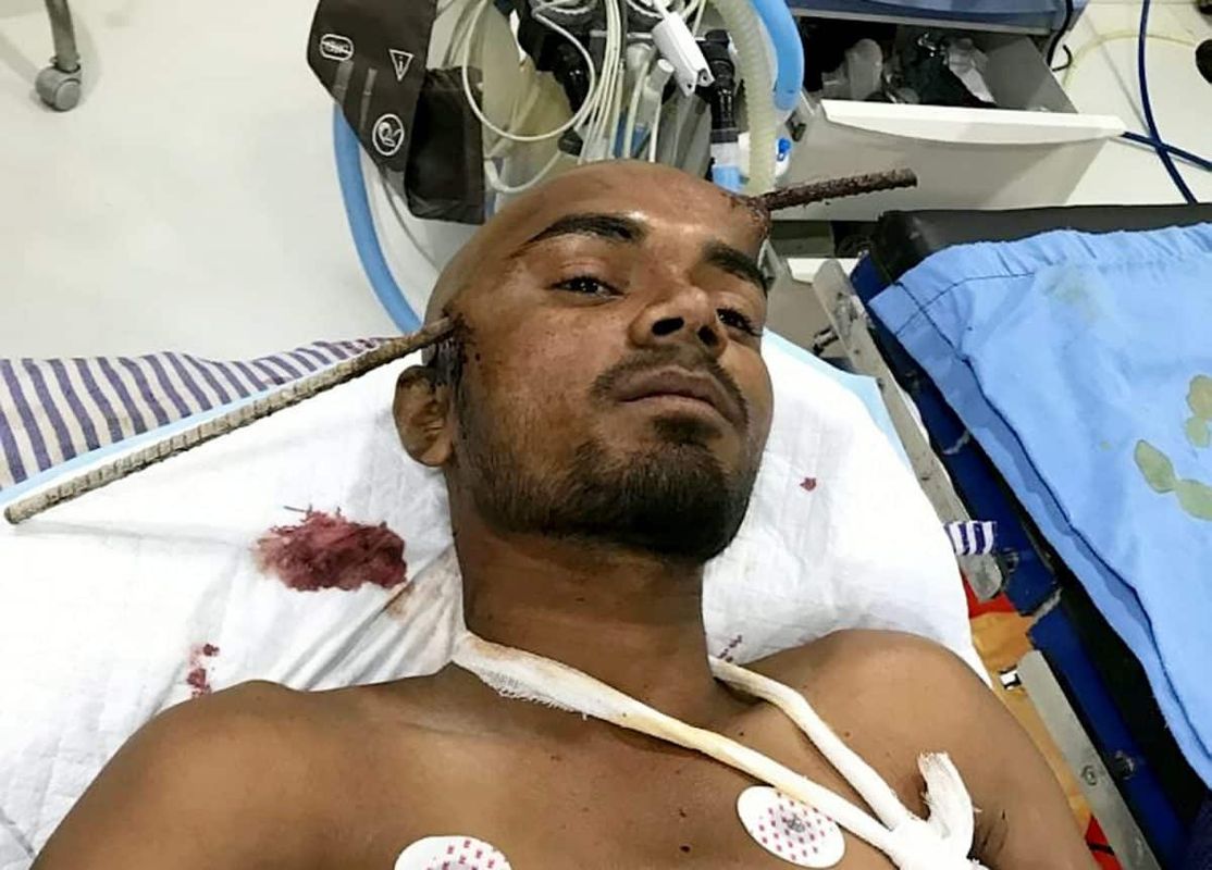 Construction worker survived falling onto this rod which went straight ...